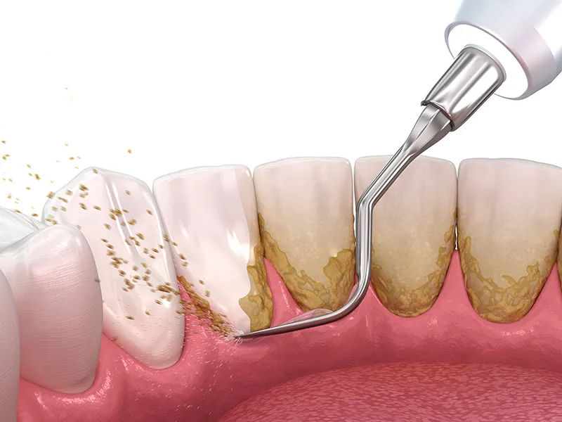 Scaling & Root Planing Redwood City CA | Gum Disease Treatment